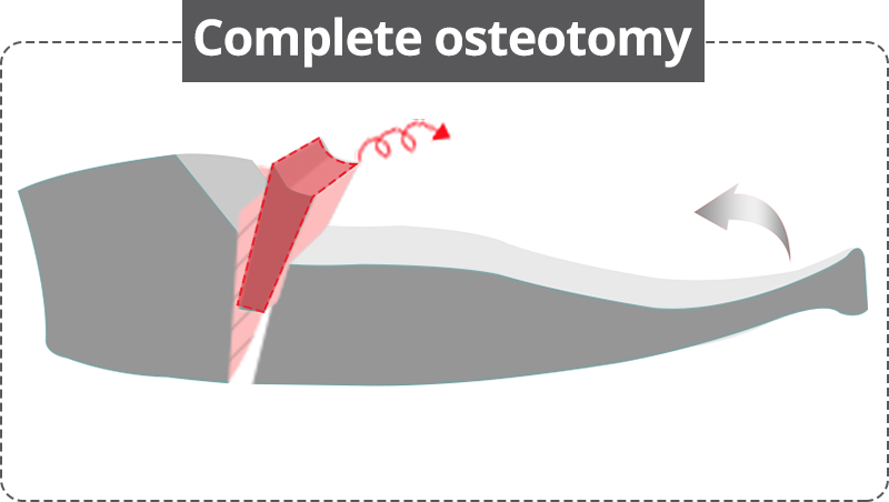 Mini Cheekbone Reduction | ID Hospital