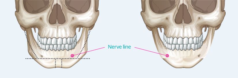 face-vline-10 (1) - IDHOSPITAL