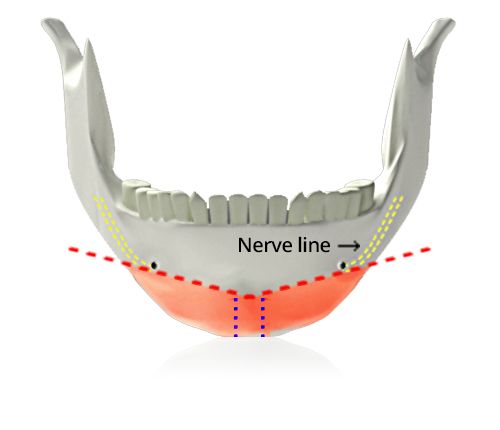 face-vline-14-1 - IDHOSPITAL