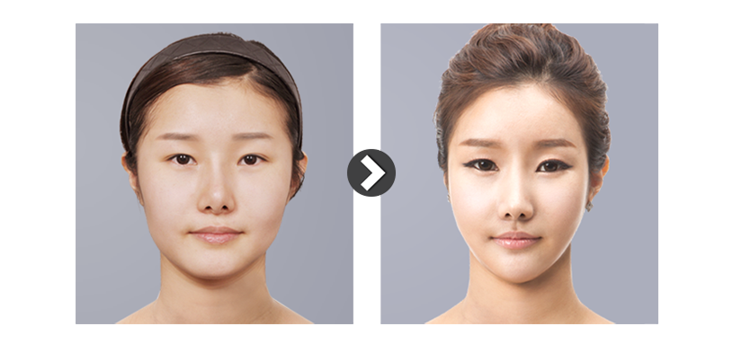 face-vline-bna-06 - IDHOSPITAL