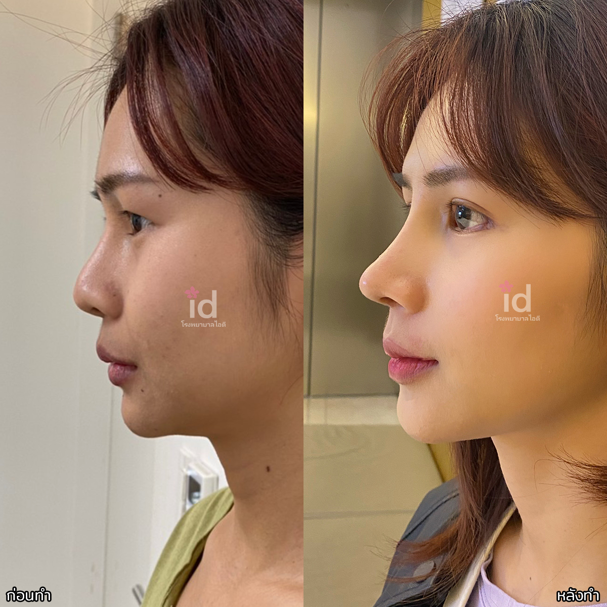 국내 거주 rungnapa 940817 Rh(re), osteo, alar, EI(MOP), LCH (C-JY, JH) 9달 ...